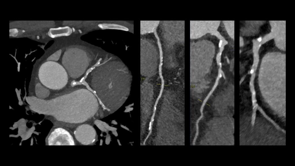 Rethink FFR Assessment for Every Patient - Siemens Healthineers USA