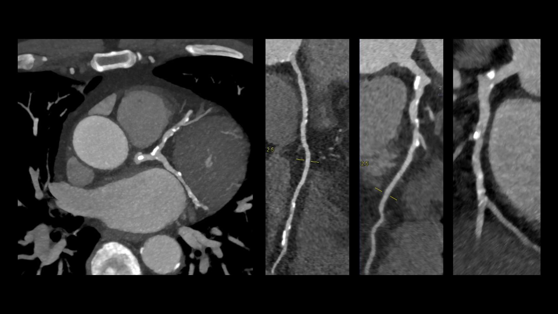 Rethink FFR assessment for every patient - Siemens Healthineers