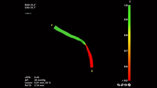 Rethink FFR Assessment for Every Patient - Siemens Healthineers USA