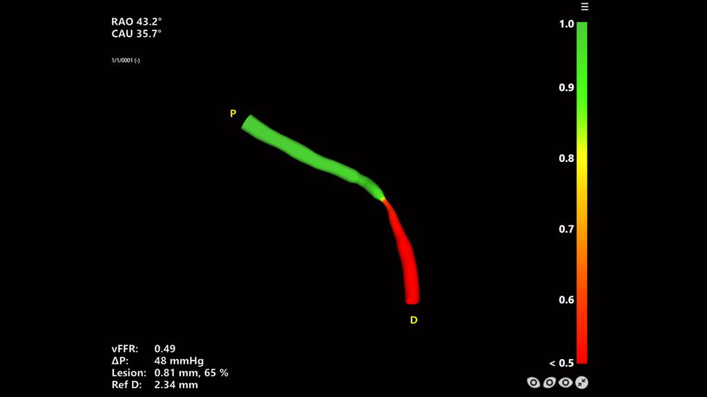 Rethink FFR Assessment for Every Patient - Siemens Healthineers USA