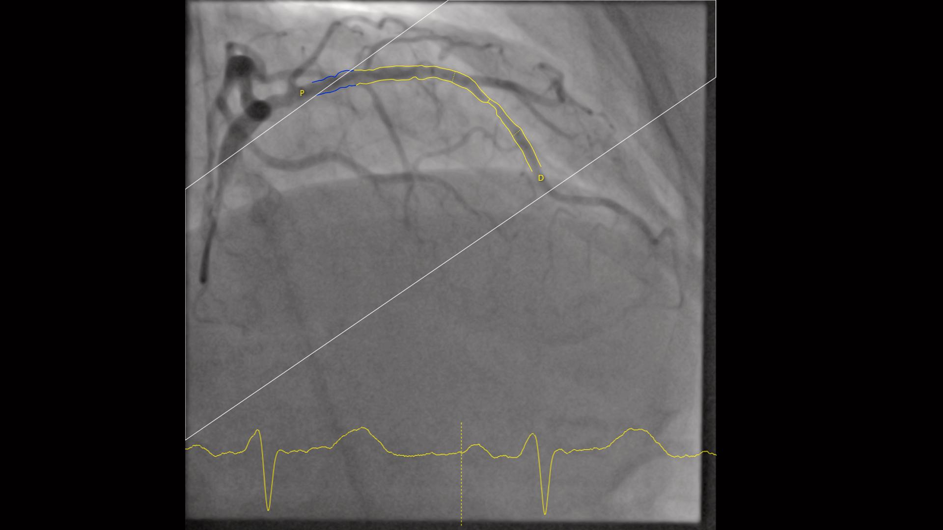 Rethink FFR Assessment for Every Patient - Siemens Healthineers USA