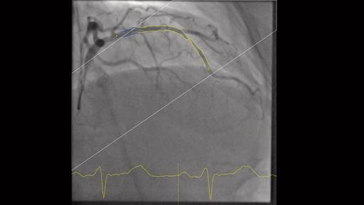 Rethink FFR Assessment for Every Patient - Siemens Healthineers USA