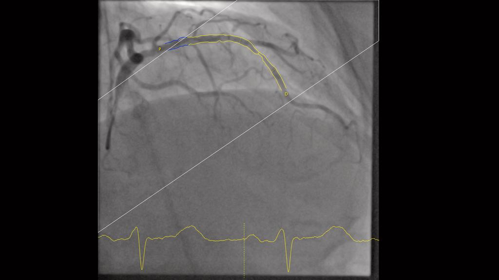 Rethink FFR Assessment for Every Patient - Siemens Healthineers USA