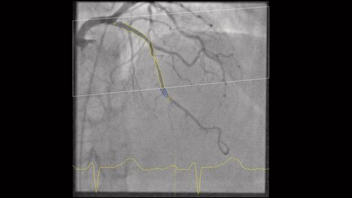Rethink FFR Assessment for Every Patient - Siemens Healthineers USA