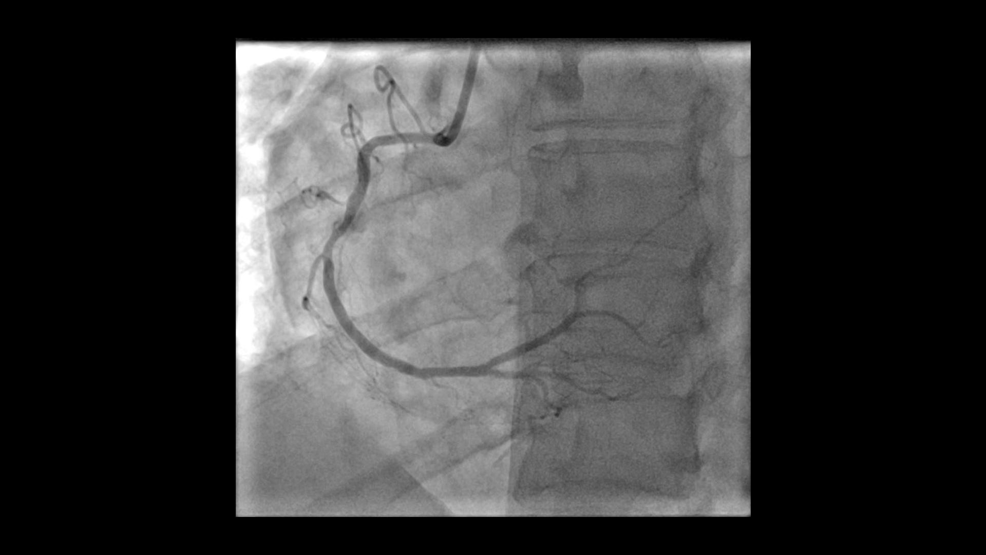 Rethink FFR assessment for every patient - Siemens Healthineers