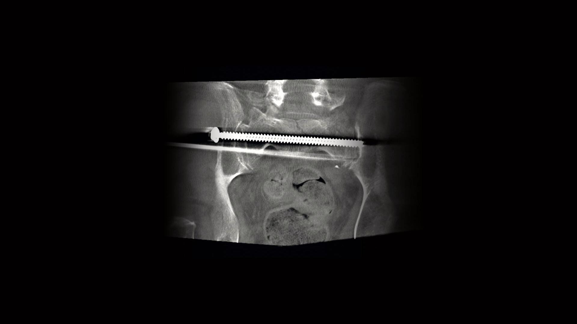 Iliosacral screw fixation in the Hybrid OR - Siemens Healthineers Schweiz