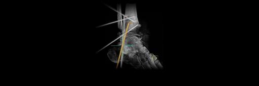 Fixation of upper ankle joint fractures - Siemens Healthineers Canada