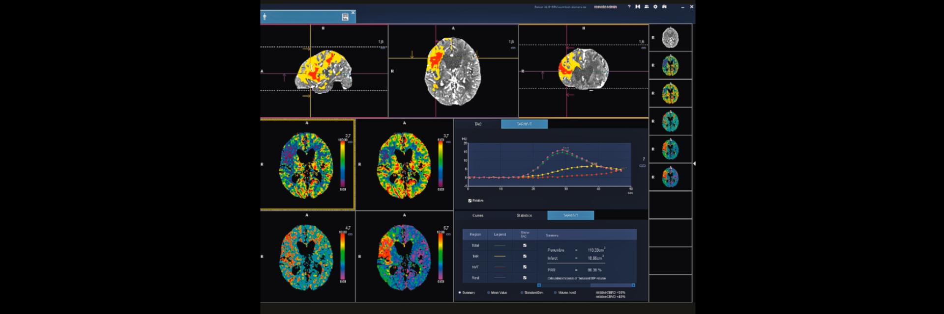 Neurology - Siemens Healthineers