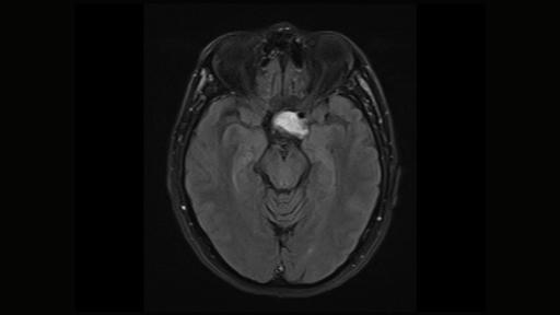 Neurosurgery - Siemens Healthineers