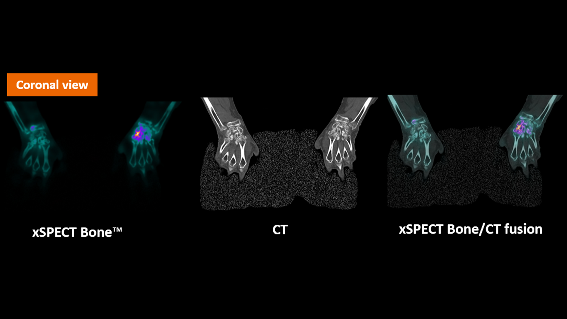 The Convergence of Nuclear Medicine and Orthopedic Surgery - Siemens ...