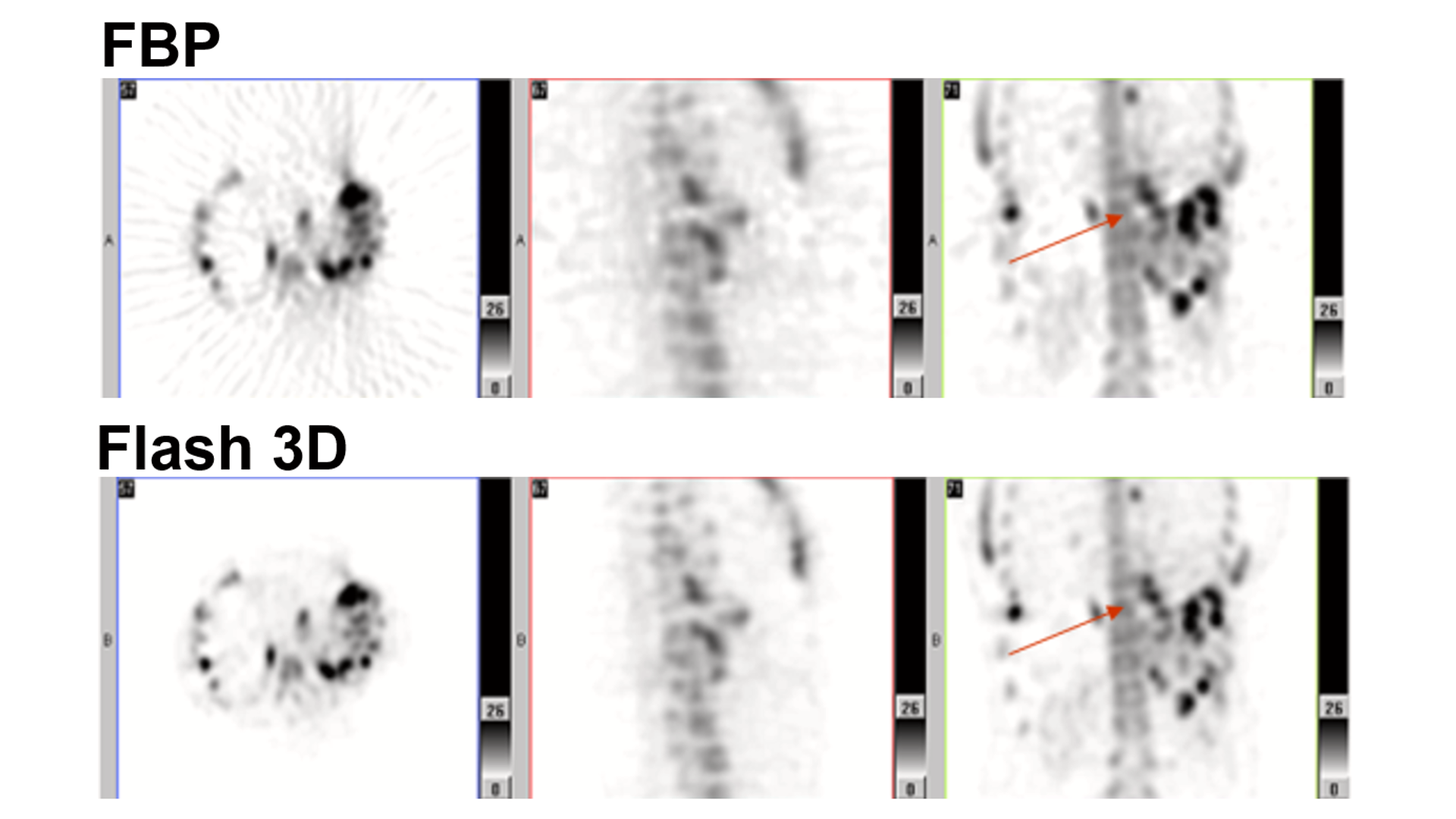 Advanced SPECT/CT Reconstruction - Siemens Healthineers Japan
