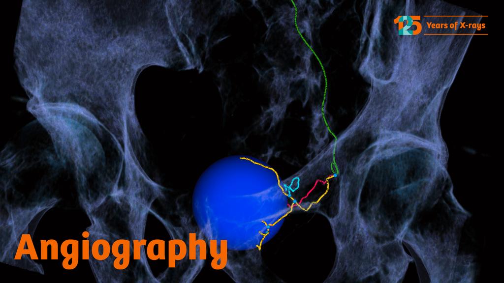 Angiography