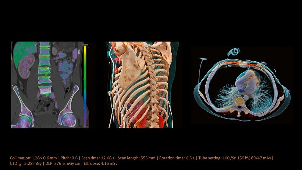 CT Scanner - SOMATOM Force - Siemens Healthineers