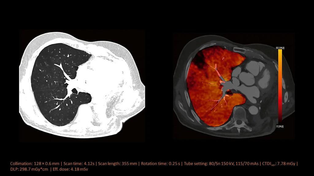 CT Scanner - SOMATOM Force - Siemens Healthineers USA