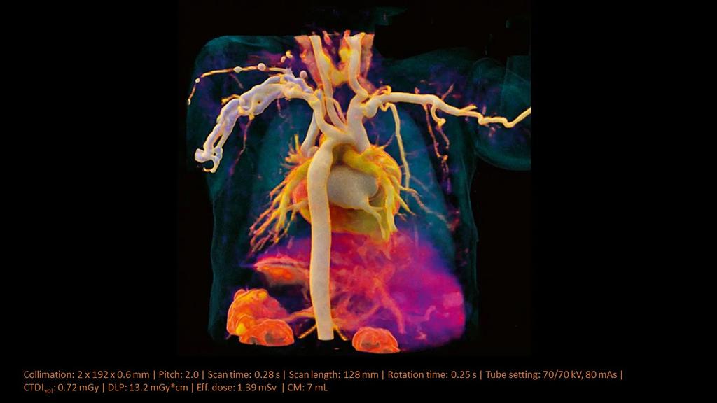 CT Scanner - SOMATOM Force - Siemens Healthineers USA