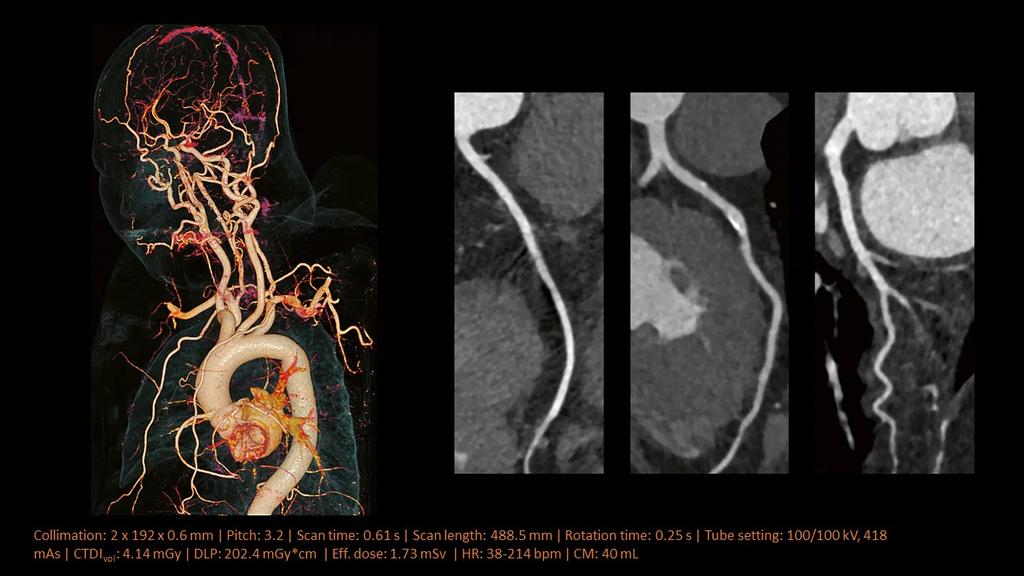 CT Scanner - SOMATOM Force - Siemens Healthineers