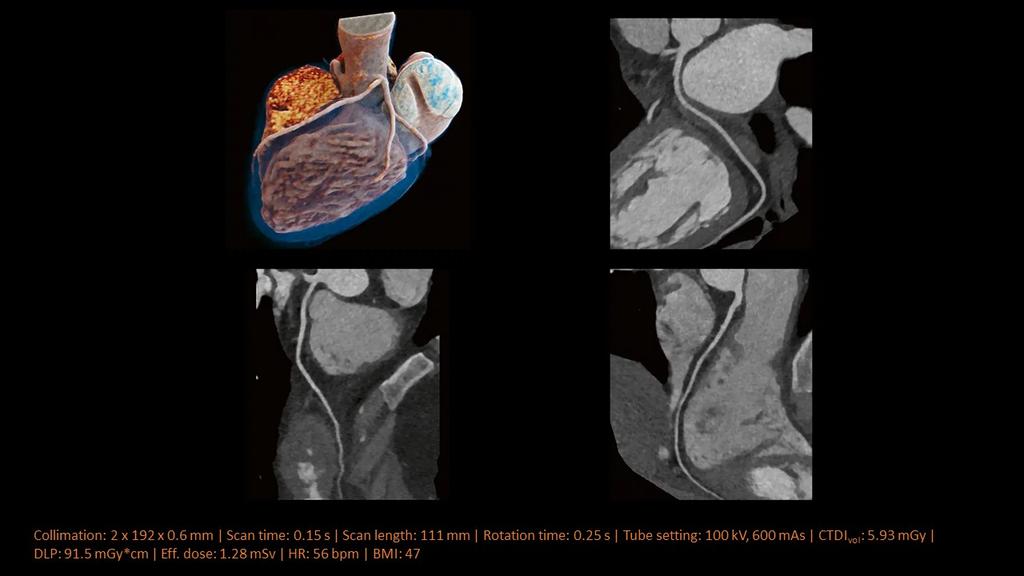 CT Scanner - SOMATOM Force - Siemens Healthineers