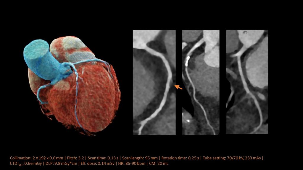 CT Scanner - SOMATOM Force - Siemens Healthineers