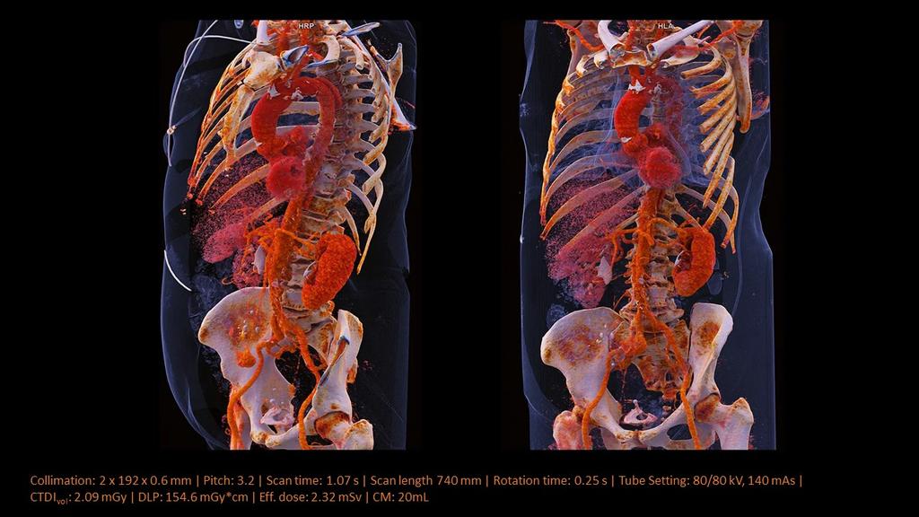CT Scanner - SOMATOM Force - Siemens Healthineers