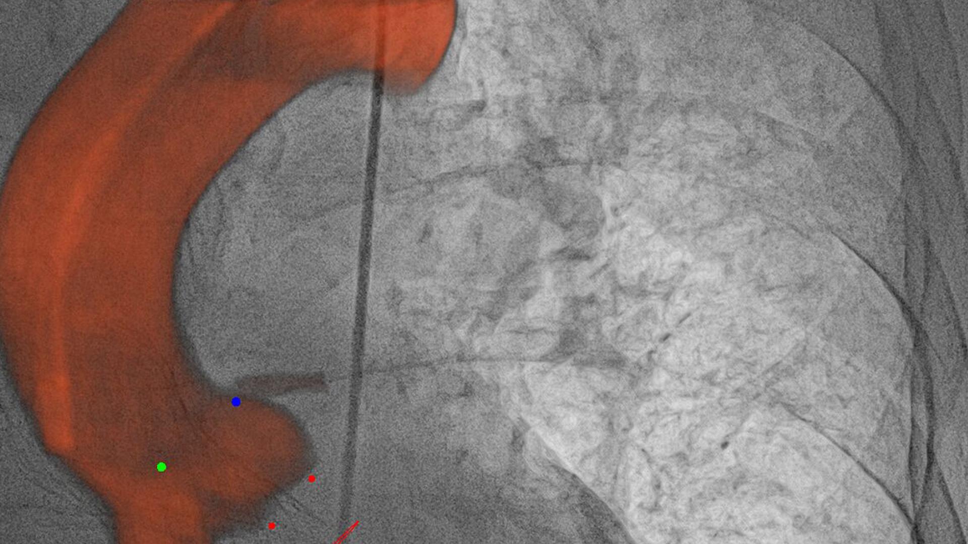 ARTIS pheno. - Siemens Healthineers Canada