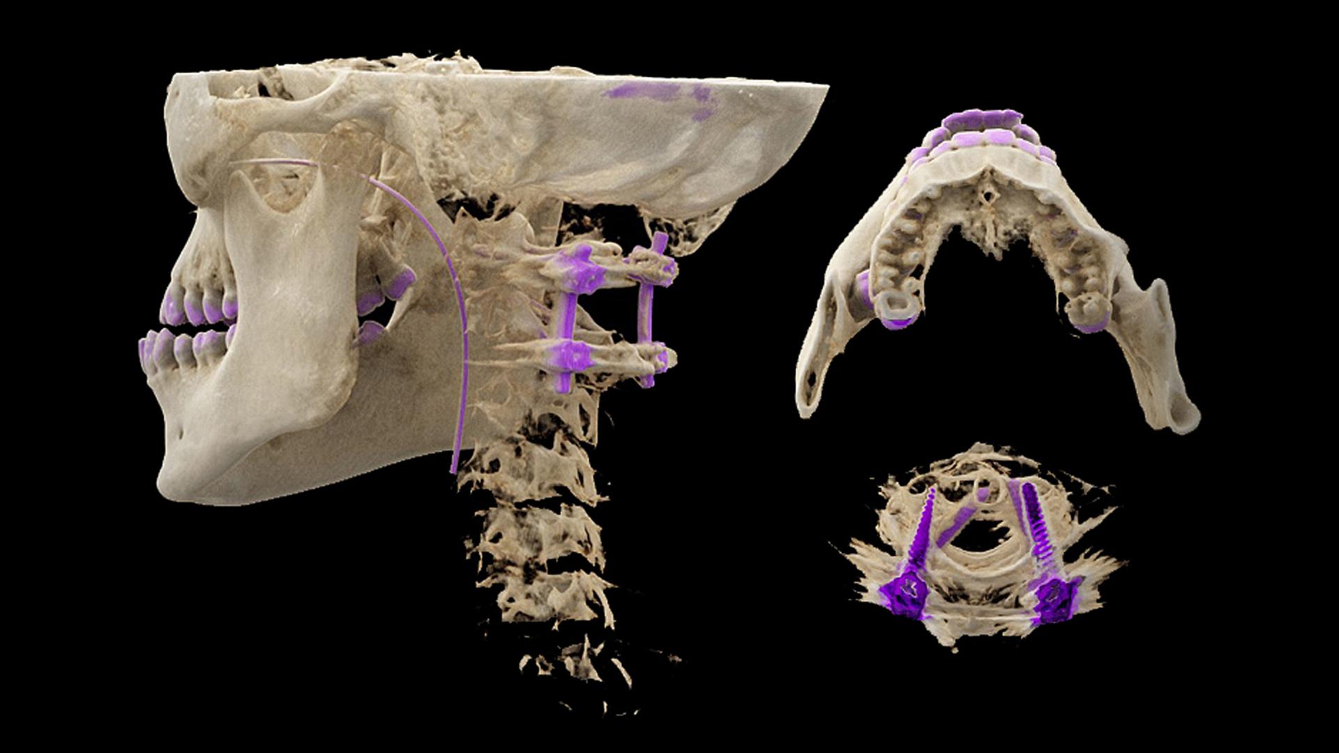ARTIS pheno. - Siemens Healthineers Canada