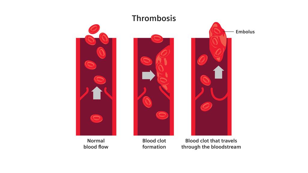 What is hemostasis? - Siemens Healthineers USA