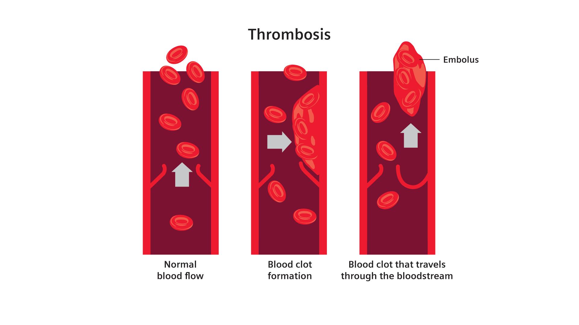 Trombosis: la enfermedad silenciosa que mata a una de cada cuatro ...