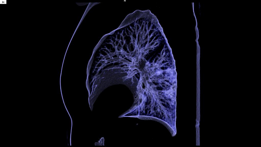 COVID-19 pneumonia – Chest X-ray or CT? - Siemens Healthineers