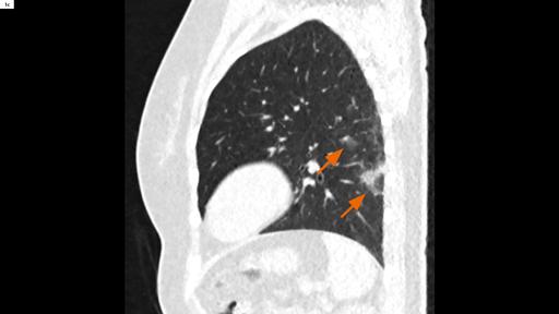 COVID-19 pneumonia – Chest X-ray or CT? - Siemens Healthineers