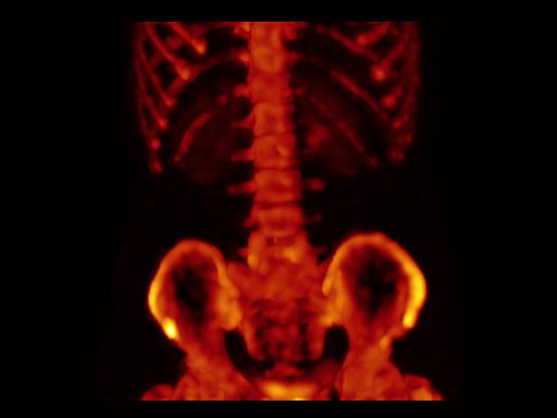 On-demand Webinar: The Role of SPECT/CT in Orthopedics - Siemens ...