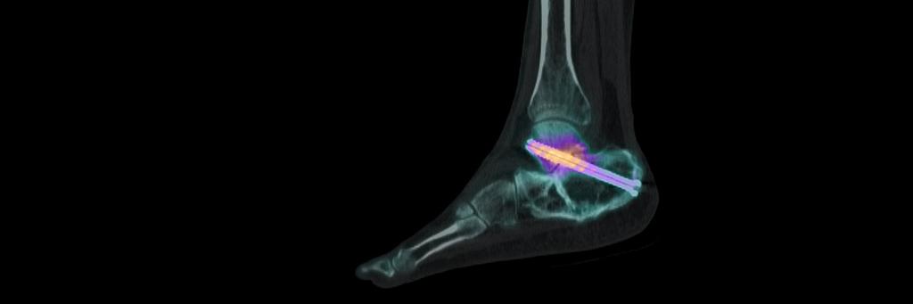xSPECT Bone: Discover what’s possible with our interactive image ...