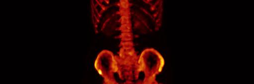 xSPECT Bone: Discover what’s possible with our interactive image ...