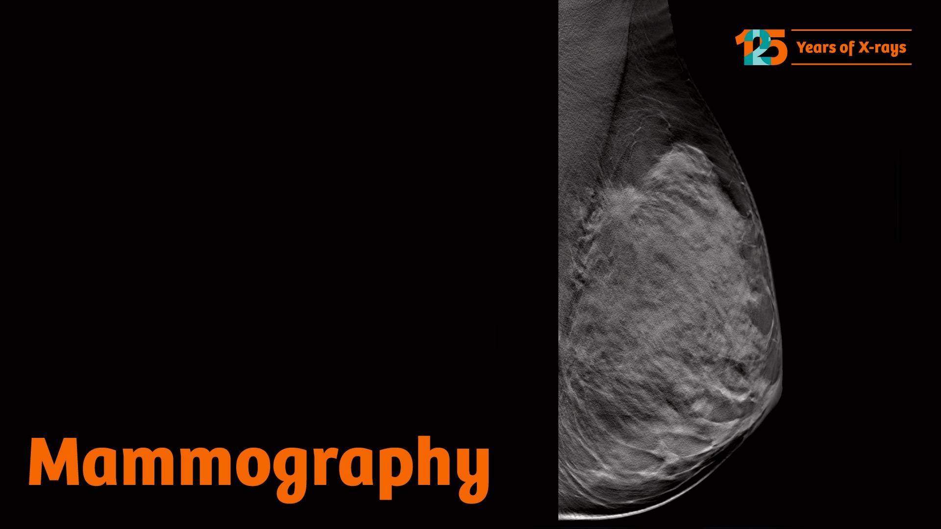 Mammography