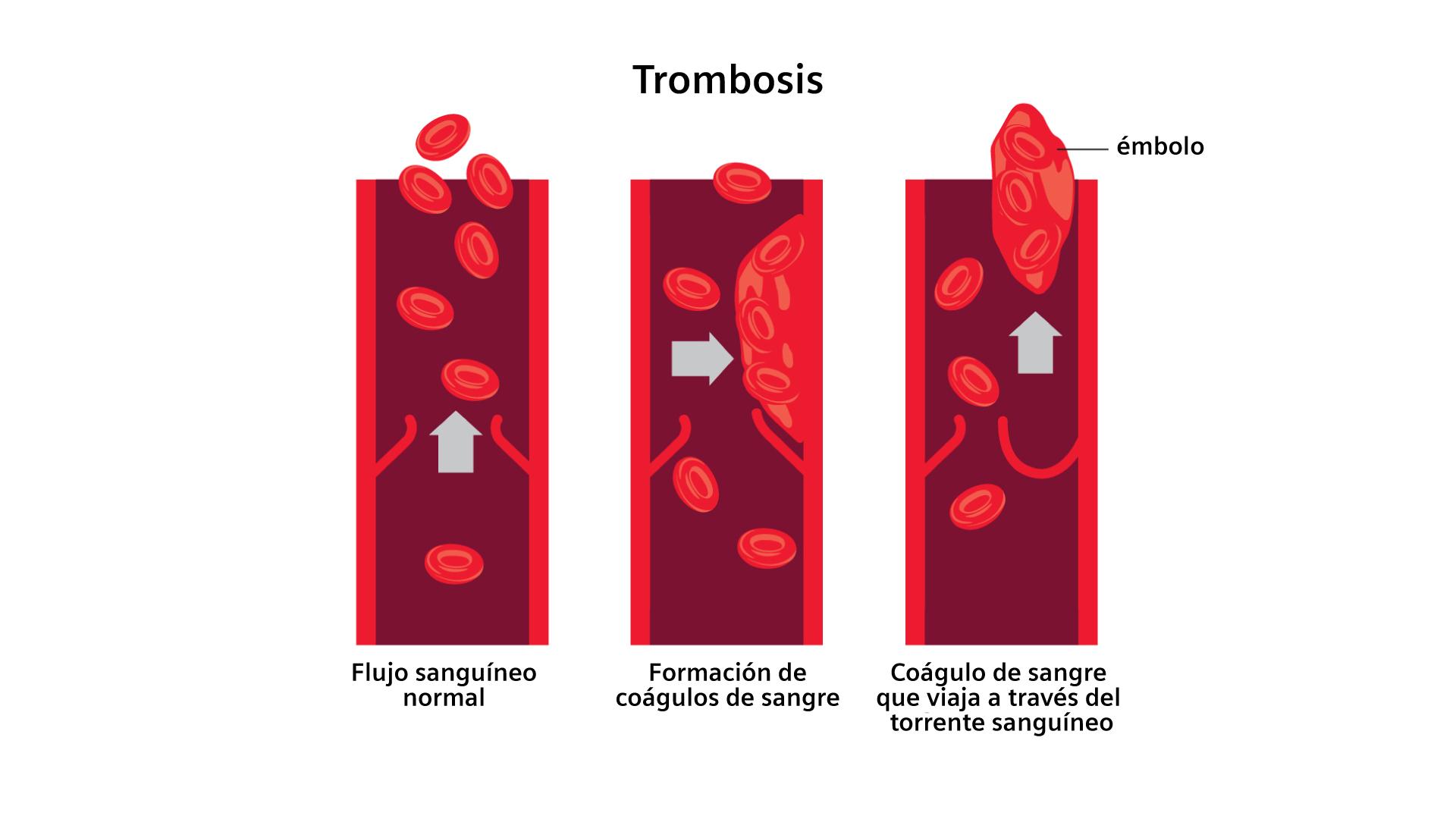 Día Mundial de Lucha contra la Trombosis - Siemens Healthineers Ecuador