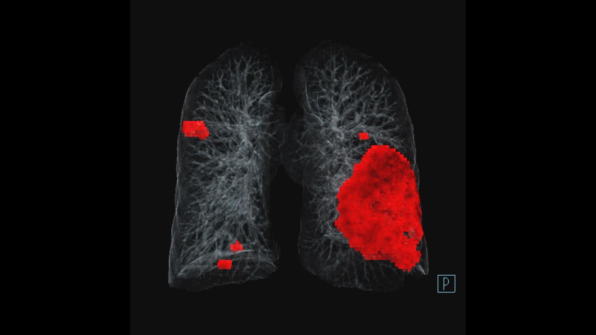 AI-Rad Companion - Siemens Healthineers USA