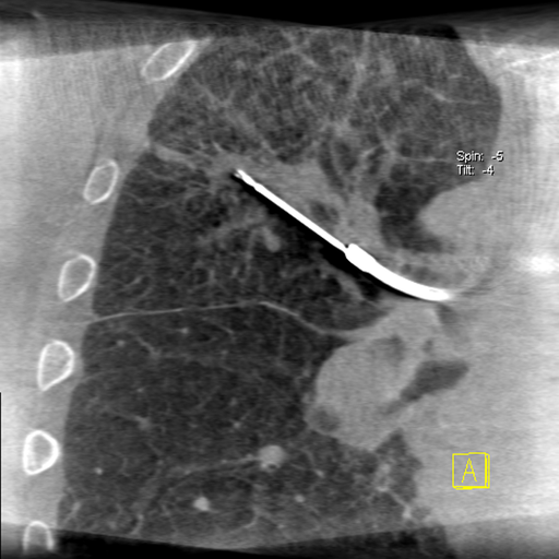 Cios Spin in endobronchial interventions - Siemens Healthineers