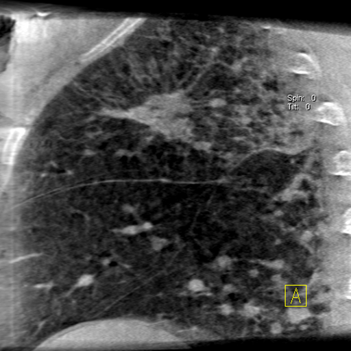 Cios Spin in endobronchial interventions - Siemens Healthineers