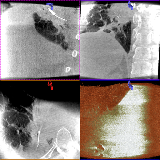 Cios Spin in endobronchial interventions - Siemens Healthineers