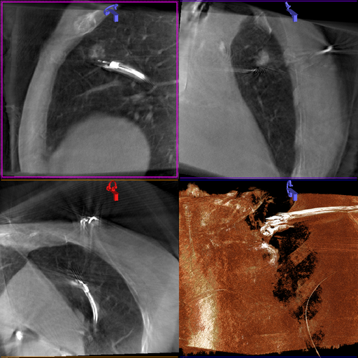 Cios Spin in endobronchial interventions - Siemens Healthineers
