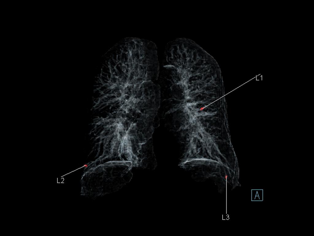 Un scanner thoracique basse dose pour une analyse multi-organes du ...