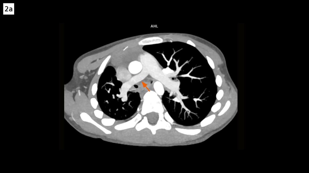 Scimitar syndrome - Siemens Healthineers