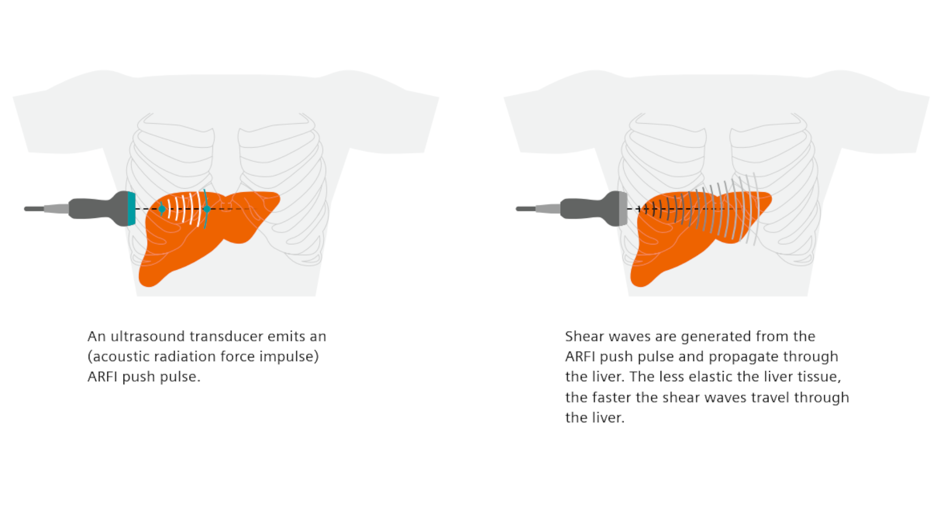 Liver fibrosis: Patients can be at risk of death even without ...