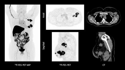 18F-FES PET/CT distinction of ER-positive lesions in a patient with ...