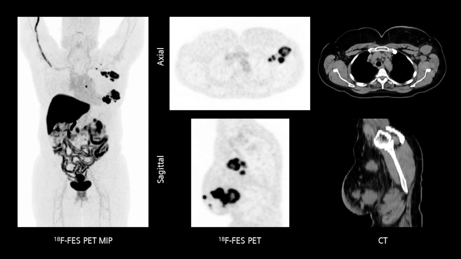 18F-FES PET/CT distinction of ER-positive lesions in a patient with ...