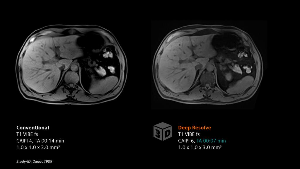 Deep Resolve - Siemens Healthineers