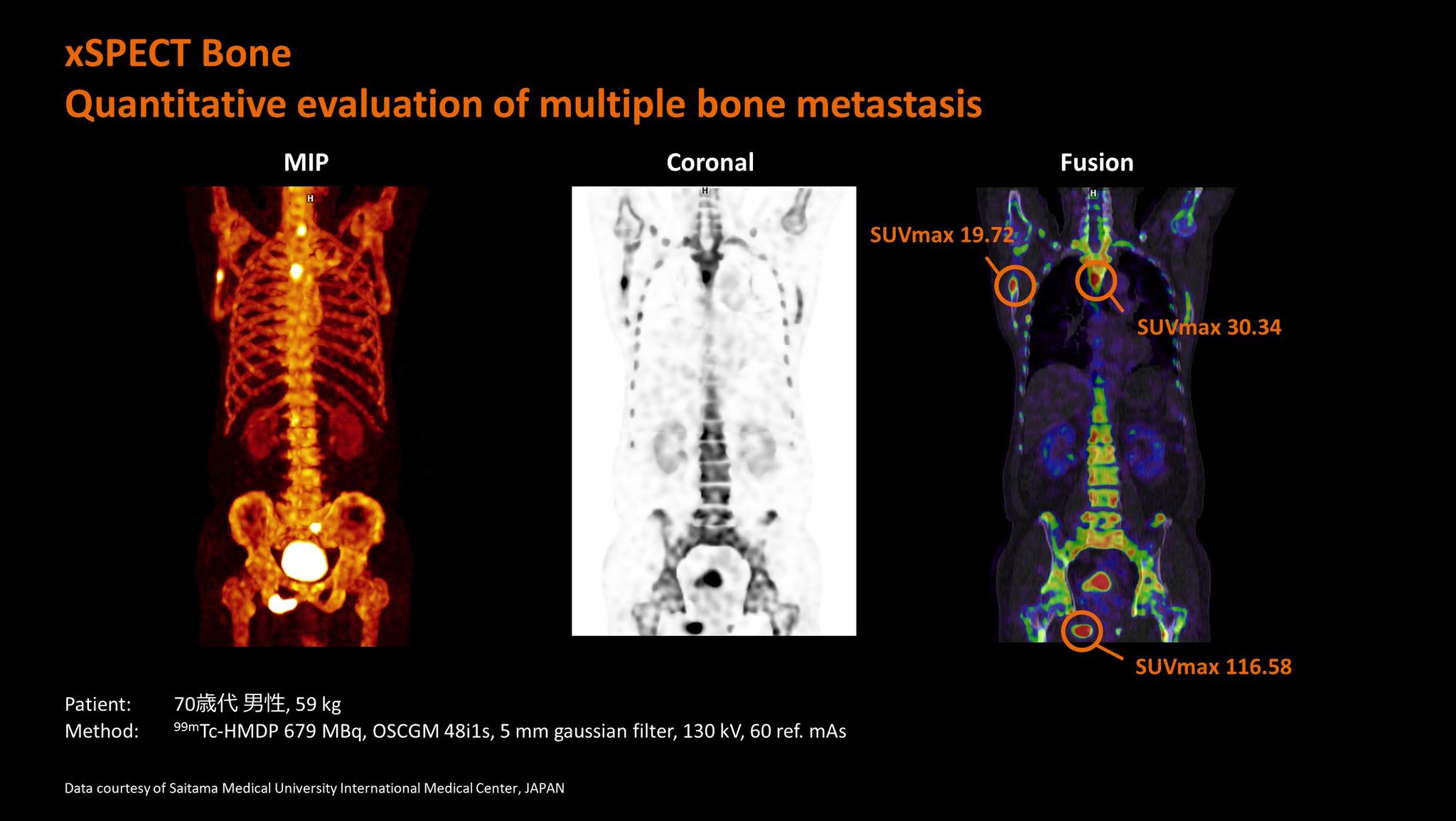 xSPECT Bone - Siemens Healthineers Japan