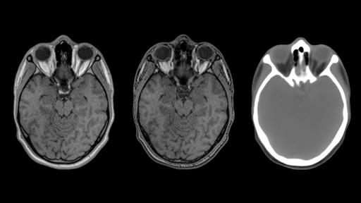 MR-only radiotherapy planning with Synthetic CT - Siemens Healthineers