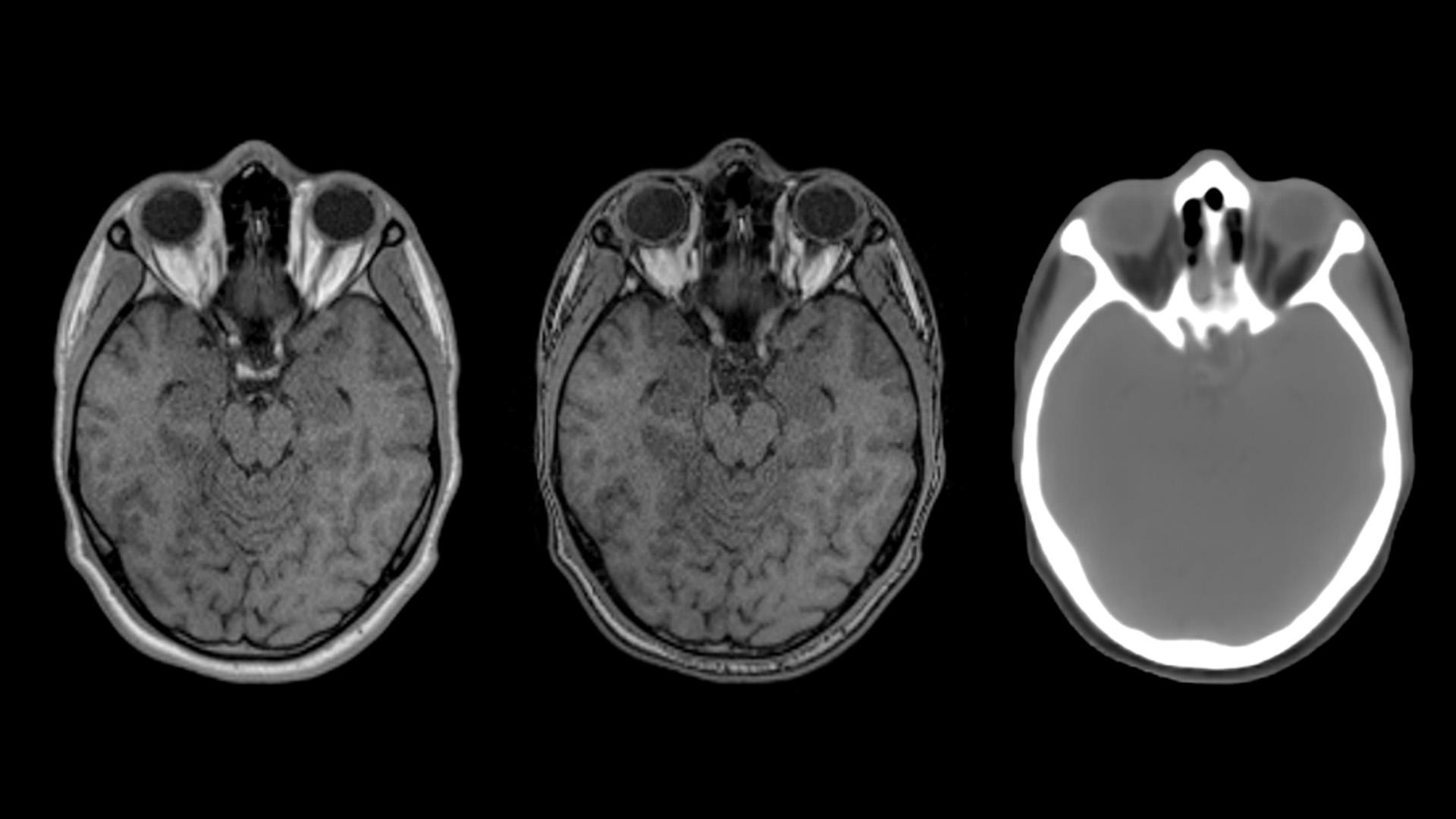 MR-only radiotherapy planning with Synthetic CT - Siemens Healthineers