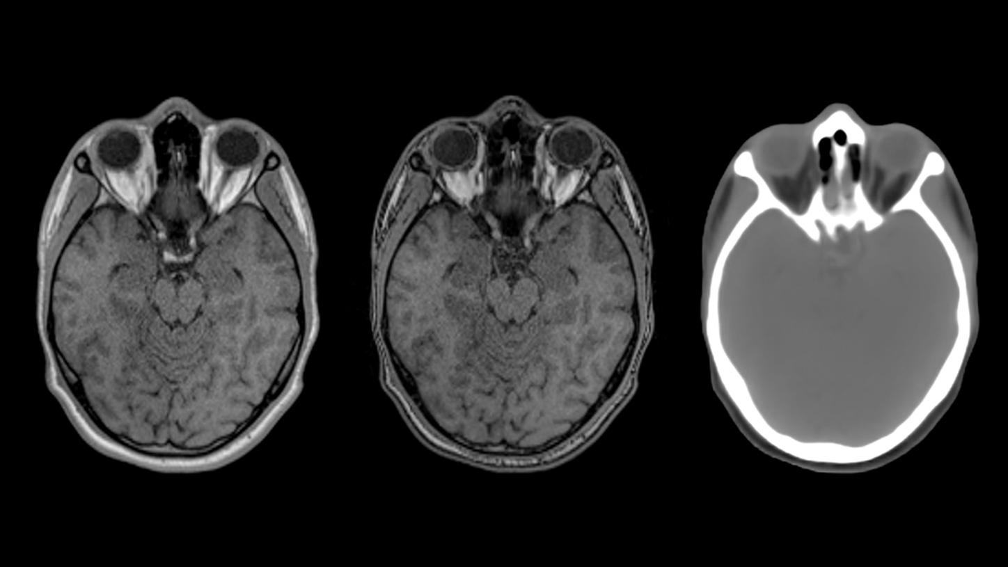 MR-only radiotherapy planning with Synthetic CT - Siemens Healthineers