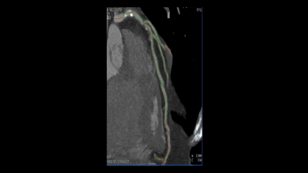 Multimodality Imaging in the Cath Lab for Guidance During CTO Treatment